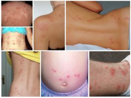 Vlooienbeten op een persoon - foto, hoe te behandelen, symptomen