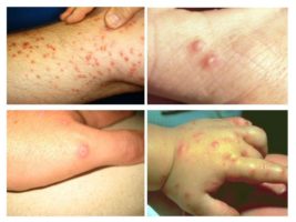 Mierenbeet - foto van huidlaesie en hoe te behandelen