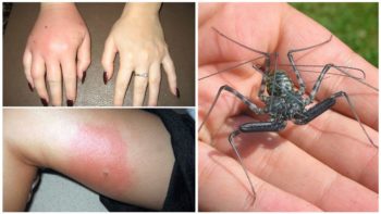 Allergic reaction to an insect bite, code according to ICD 10